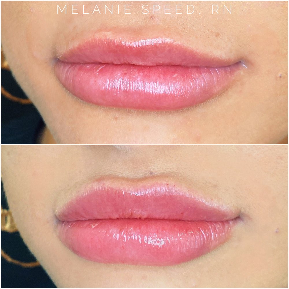 Flawless Aesthetics by Melanie Speed, RN in Beverly Hills | Flawless ...